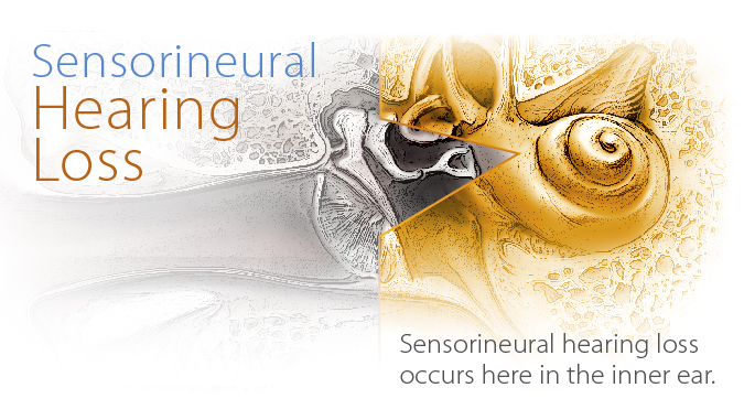 Sensorineural Hearing Loss | Luebbe Hearing Services